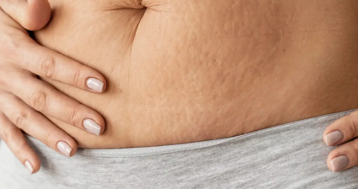 Effective Stretch Mark Treatment in Hyderabad | Coral Skin Clinic